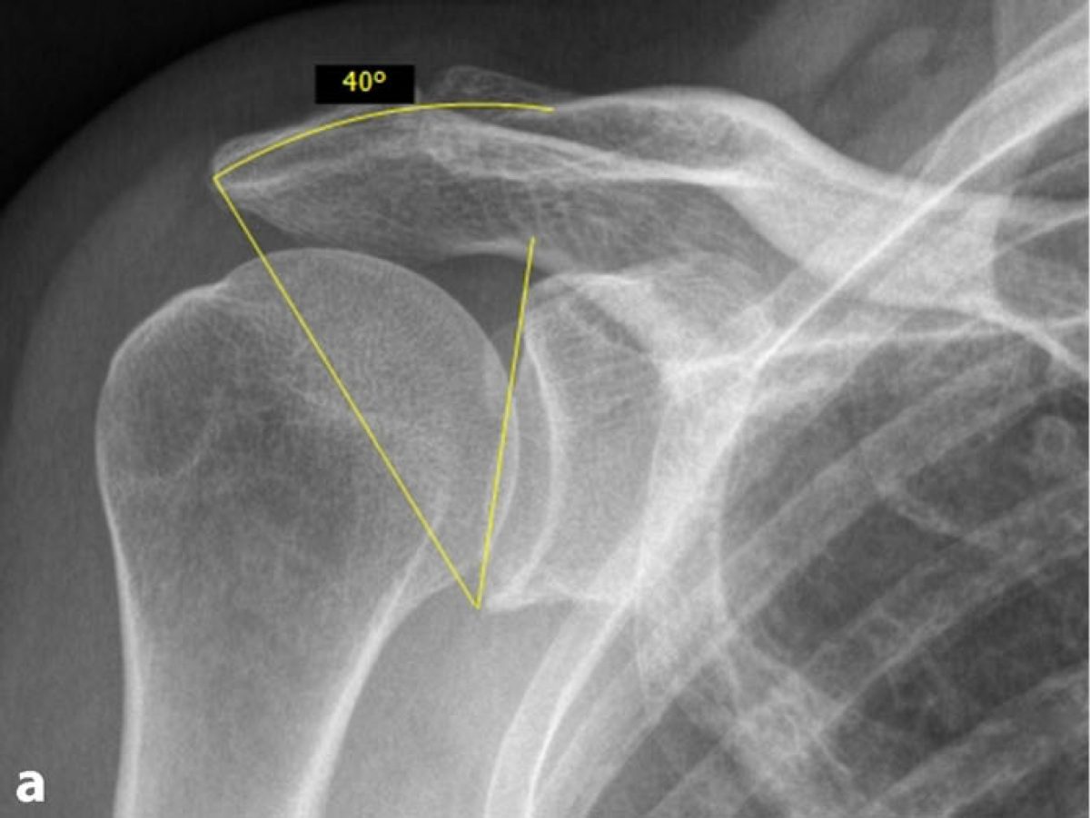 Lateral acromioplasty for correction of the critical shoulder angle ...