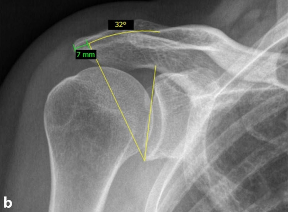 Lateral acromioplasty for correction of the critical shoulder angle ...